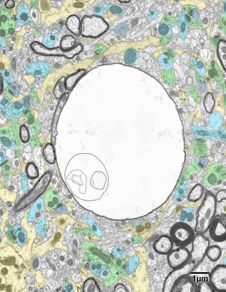 Chapter 7 – myelin balloons » Fine Structure of the Aging Brain ...