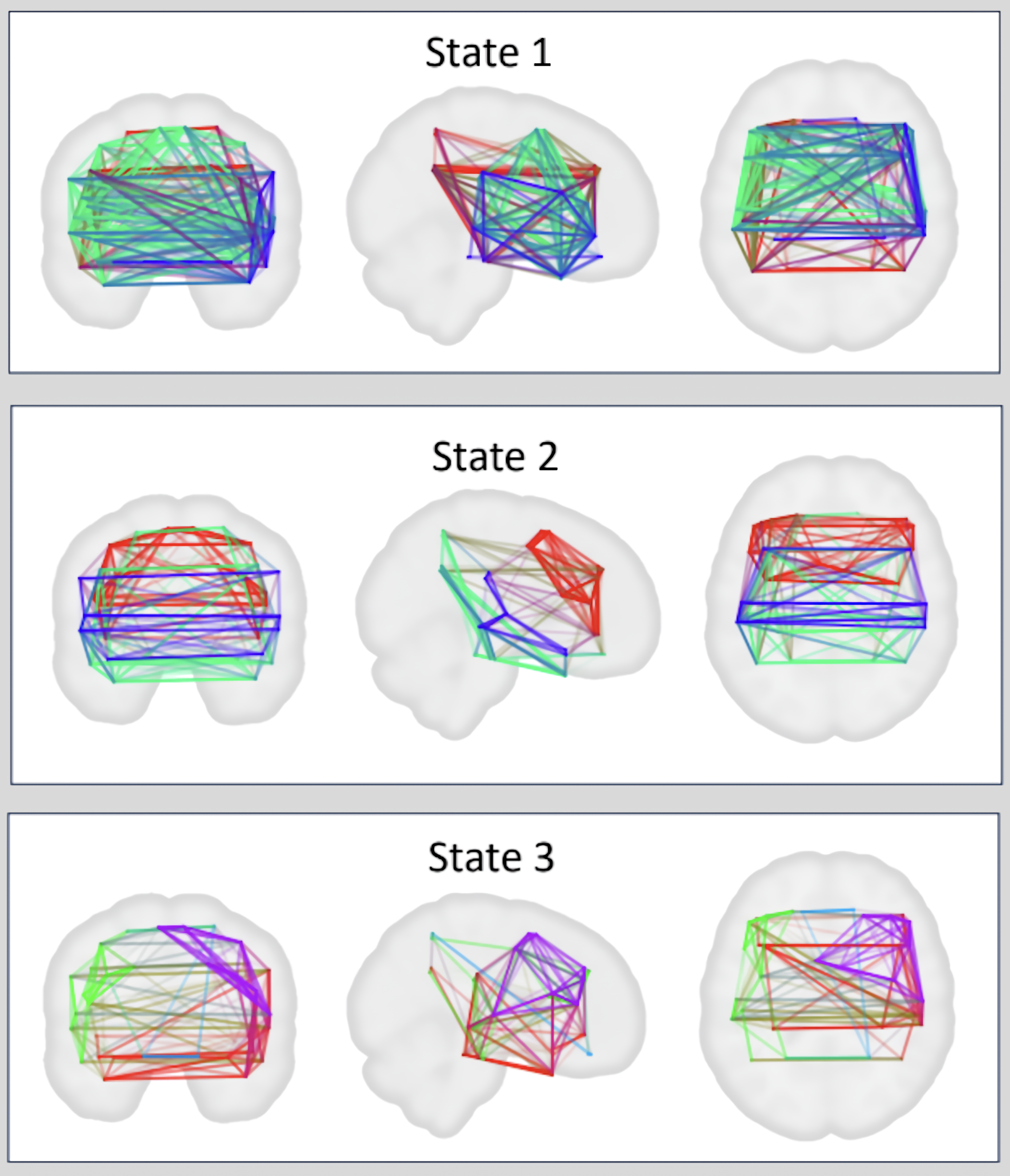Mapping Recovery: Understanding Aphasia Recovery Through Neuroimaging ...
