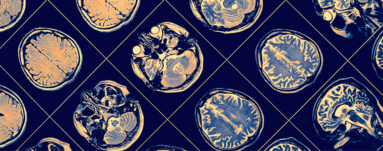 Bu School Of Medicine Leveraging Deep Learning Algorithm To Help With