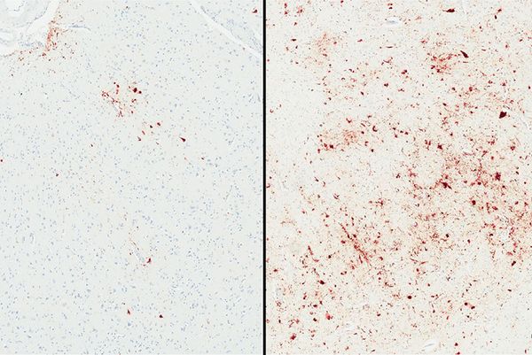 TMEM106B Gene Linked to Severe CTE Symptoms | The Brink | Boston University