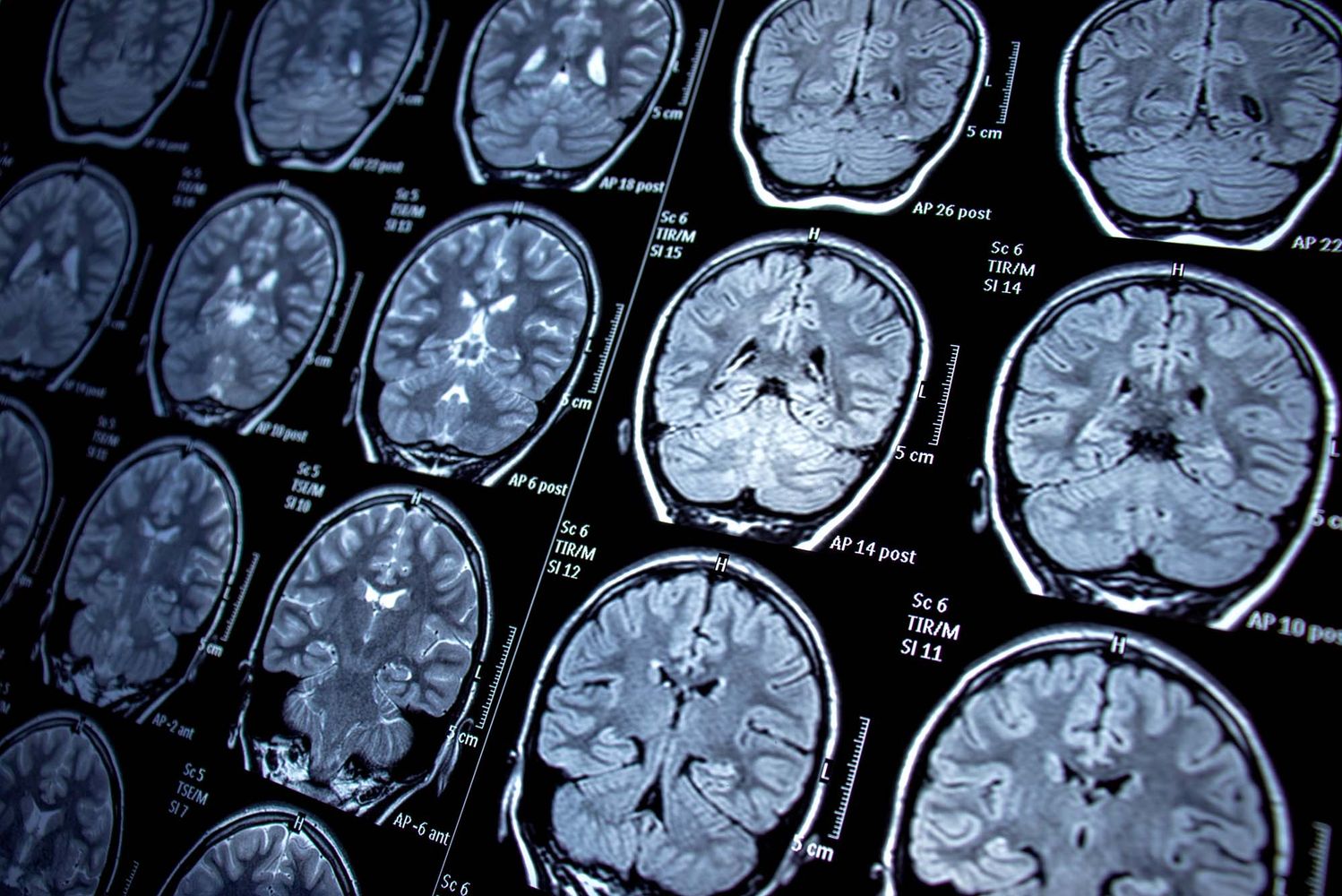 New BU Center for Brain Recovery Aims to Advance Treatments for Stroke ...